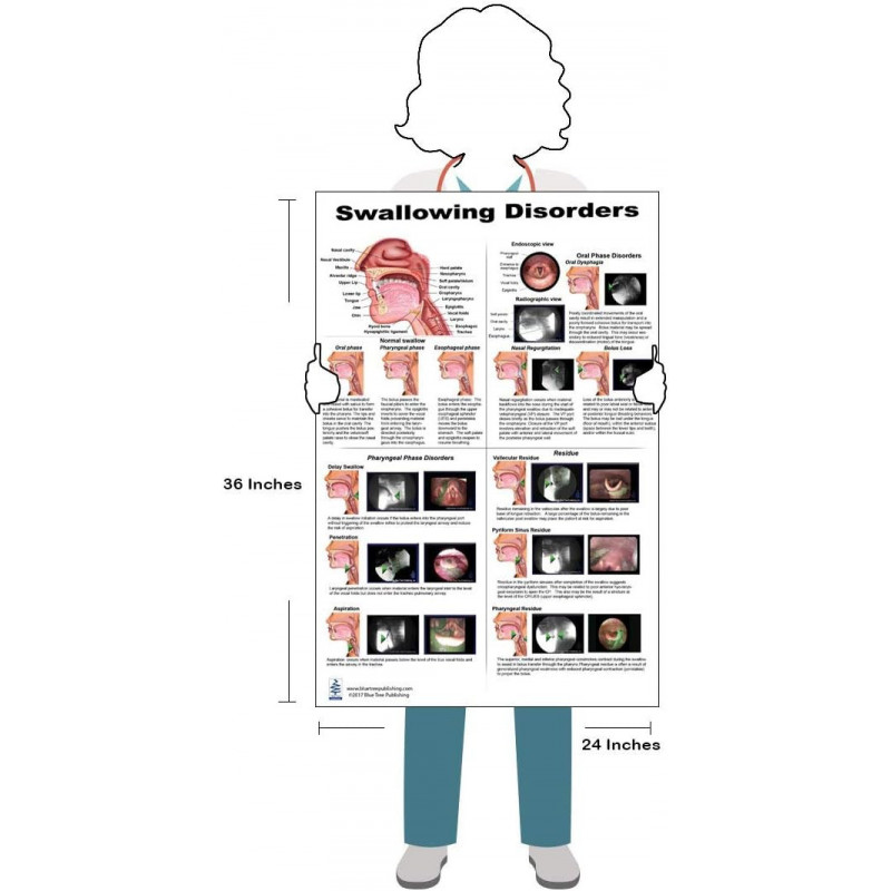 Swallow Disorders Large Poster, Anatomy, Dysphagia, Endoscopic View ...