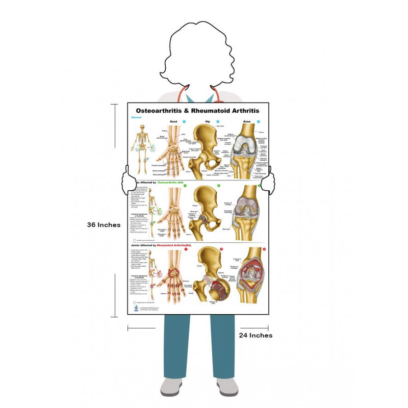 Osteoarthritis & Rheumatoid Arthritis Large Poster