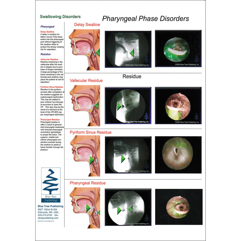 Swallowing Disorders Anatomical Chart