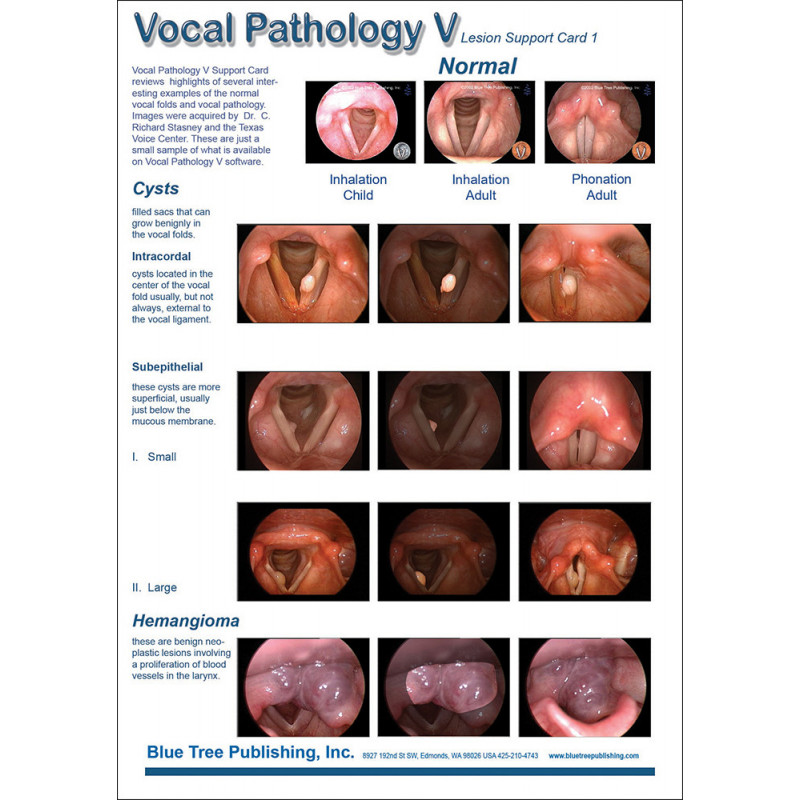 Vocal Pathology 5 Chart Set Lesions