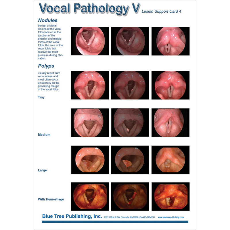 Vocal Pathology 5 Chart Set, Lesions