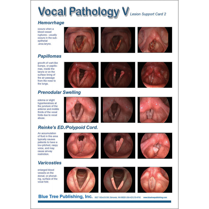 Vocal Pathology 5 Chart Set Lesions