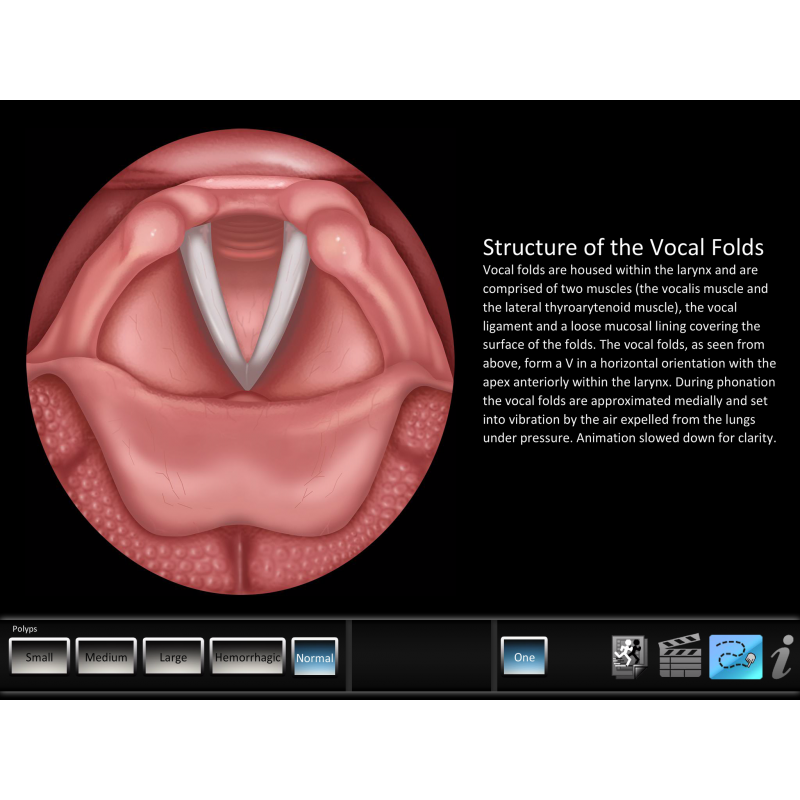 Vocal Pathology: Polyps App