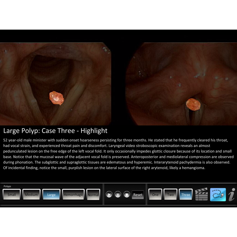 Vocal Pathology: Polyps App
