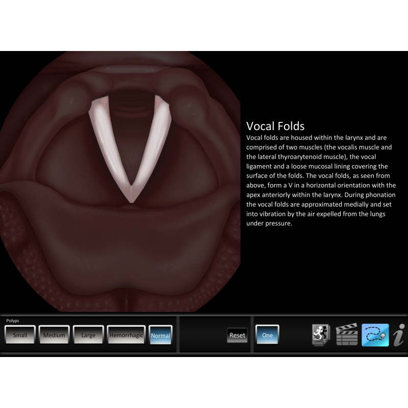 Vocal Pathology: Polyps App