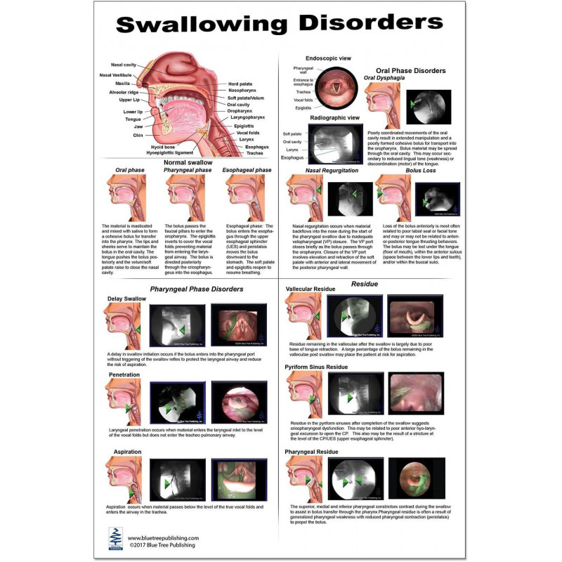 Swallowing, Swallowing Disorder, Child Swallowing Disorders Large Poster Set